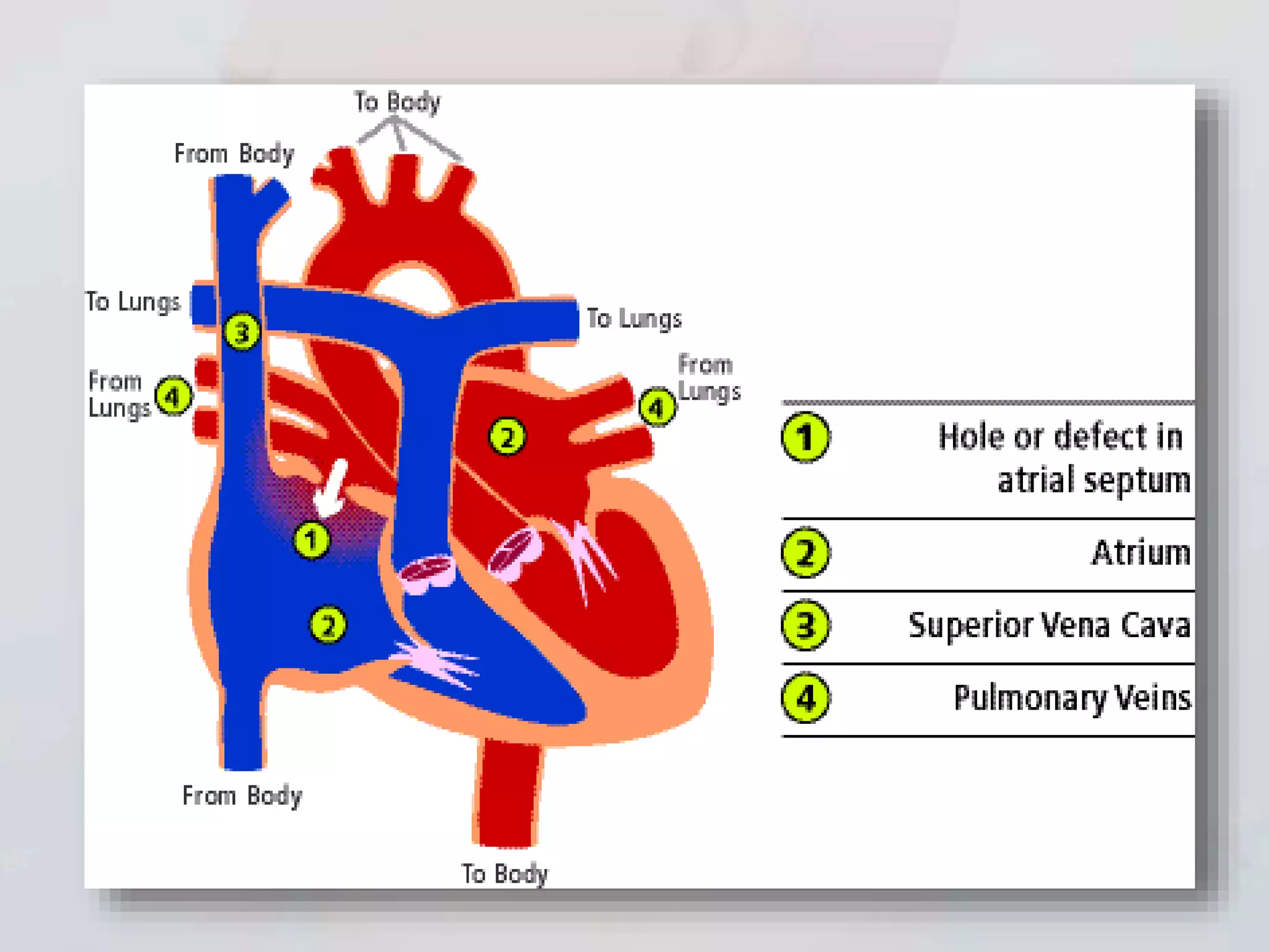Congenital heart defects | PPT
