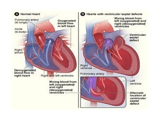 Congenital heart defects.pptxvgggffddsssdrr | PPTX