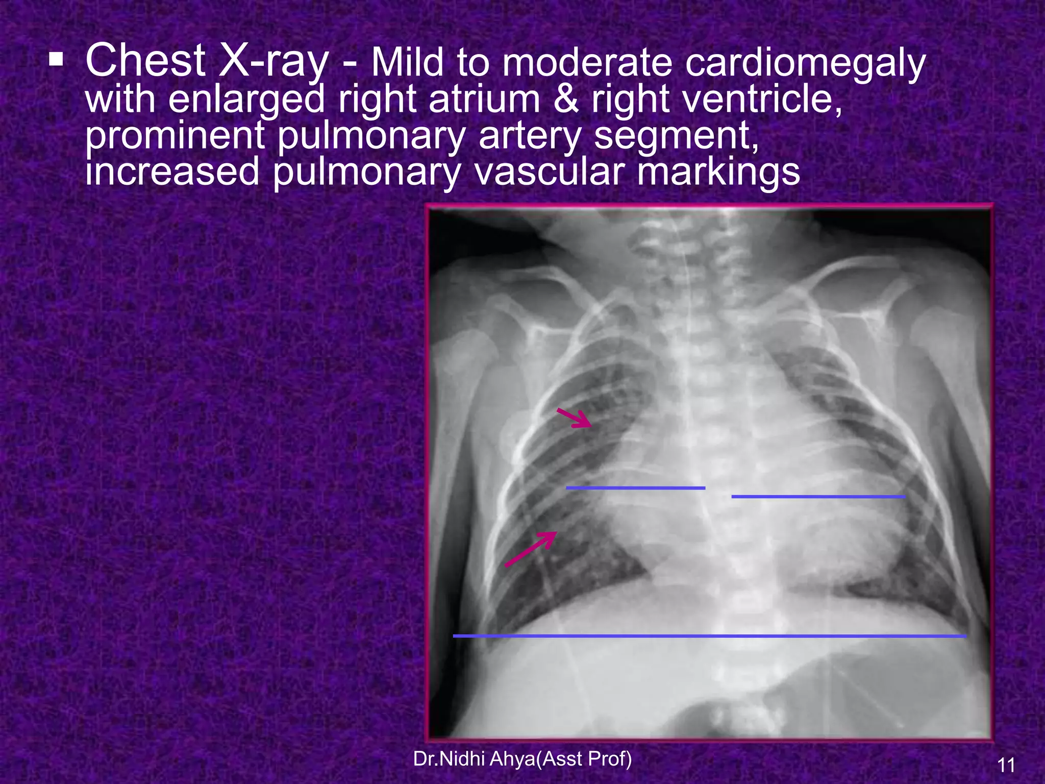 Congenital heart disease | PPTX