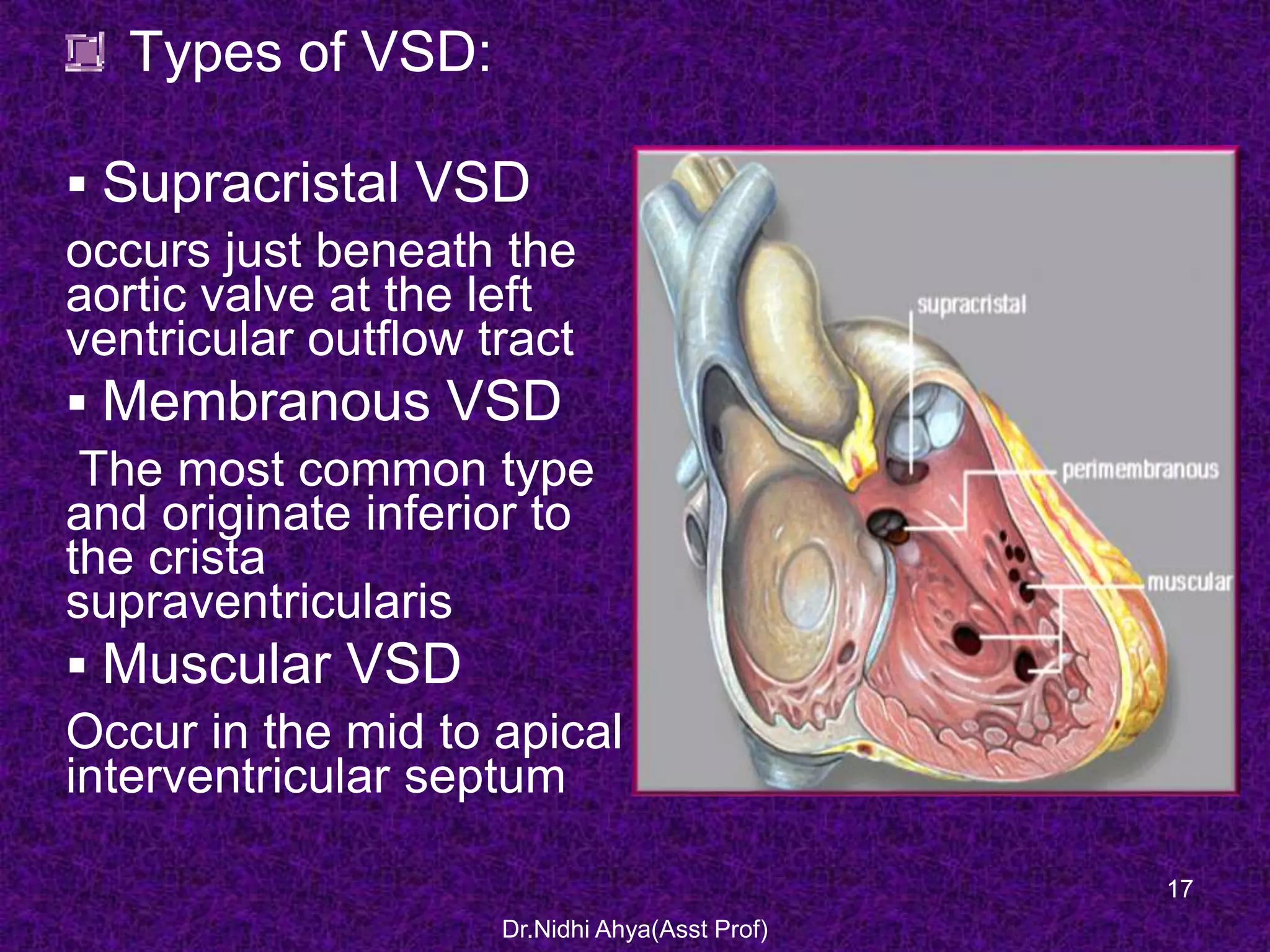 Congenital heart disease | PPTX