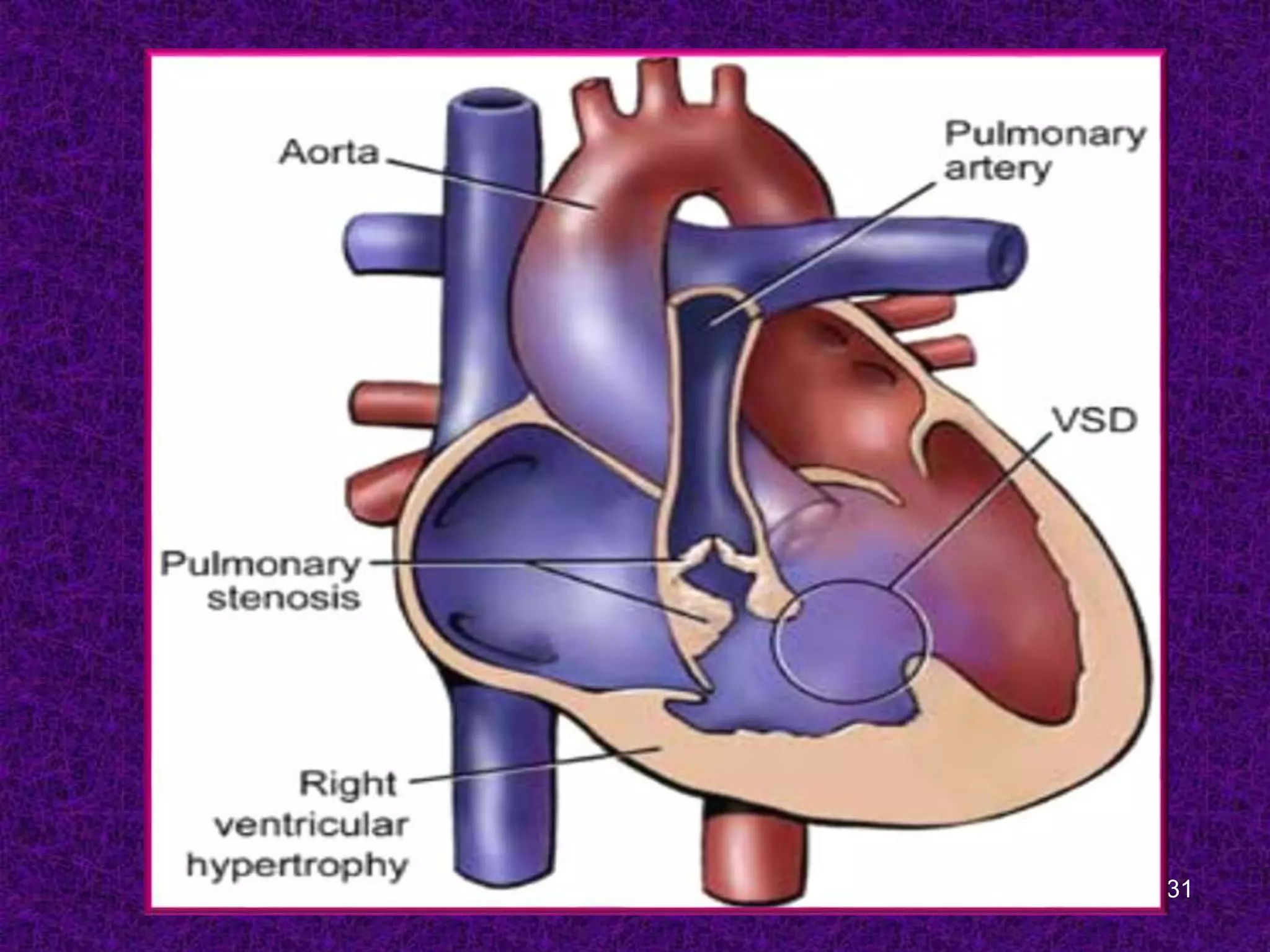 Congenital heart disease | PPTX