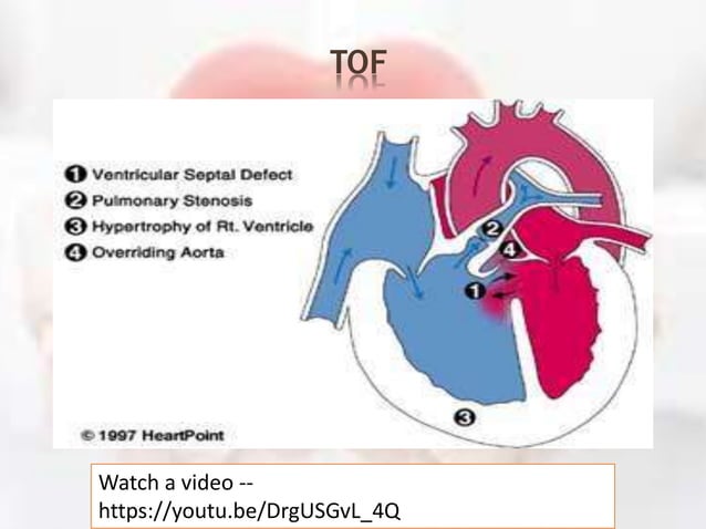 Congenital heart disease | PPT