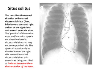 Congenital heart disease | PPT