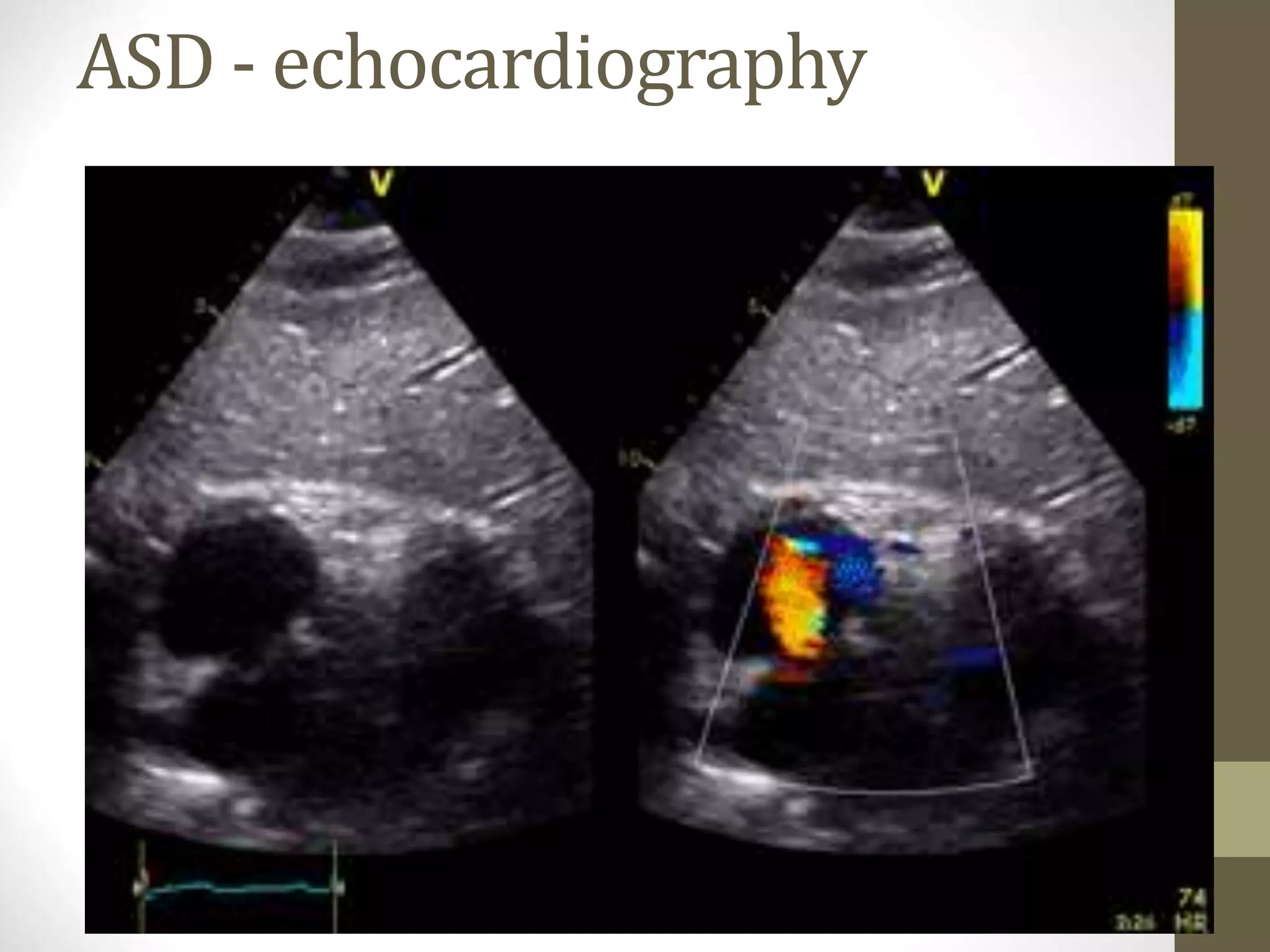 Congenital Heart Disease.ppt
