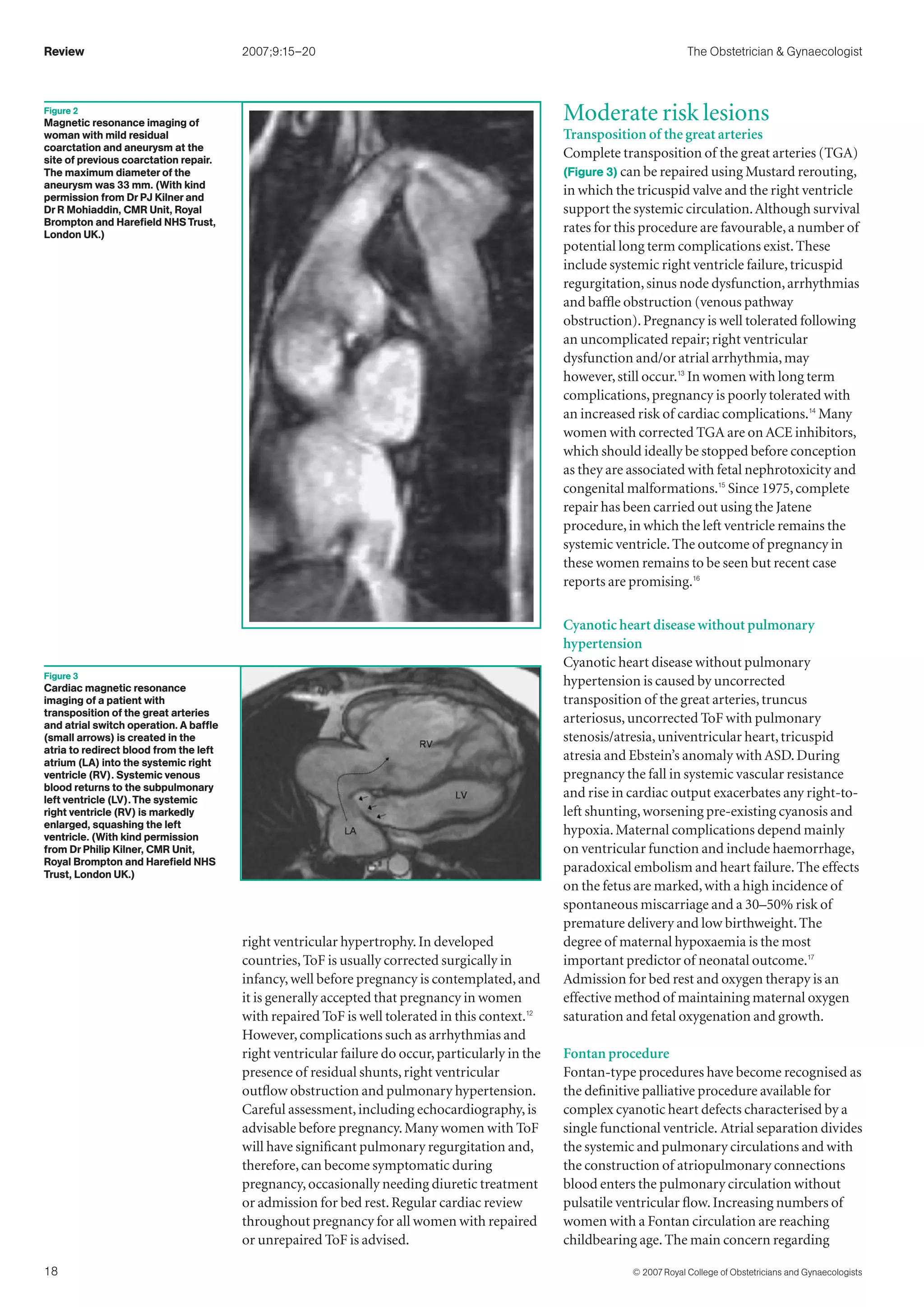 congenital heart disease.pdf