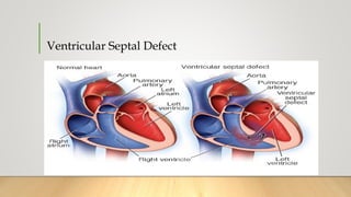 Congenital heart disease | PPT