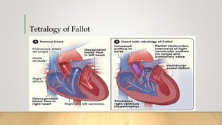 Congenital heart disease | PPT