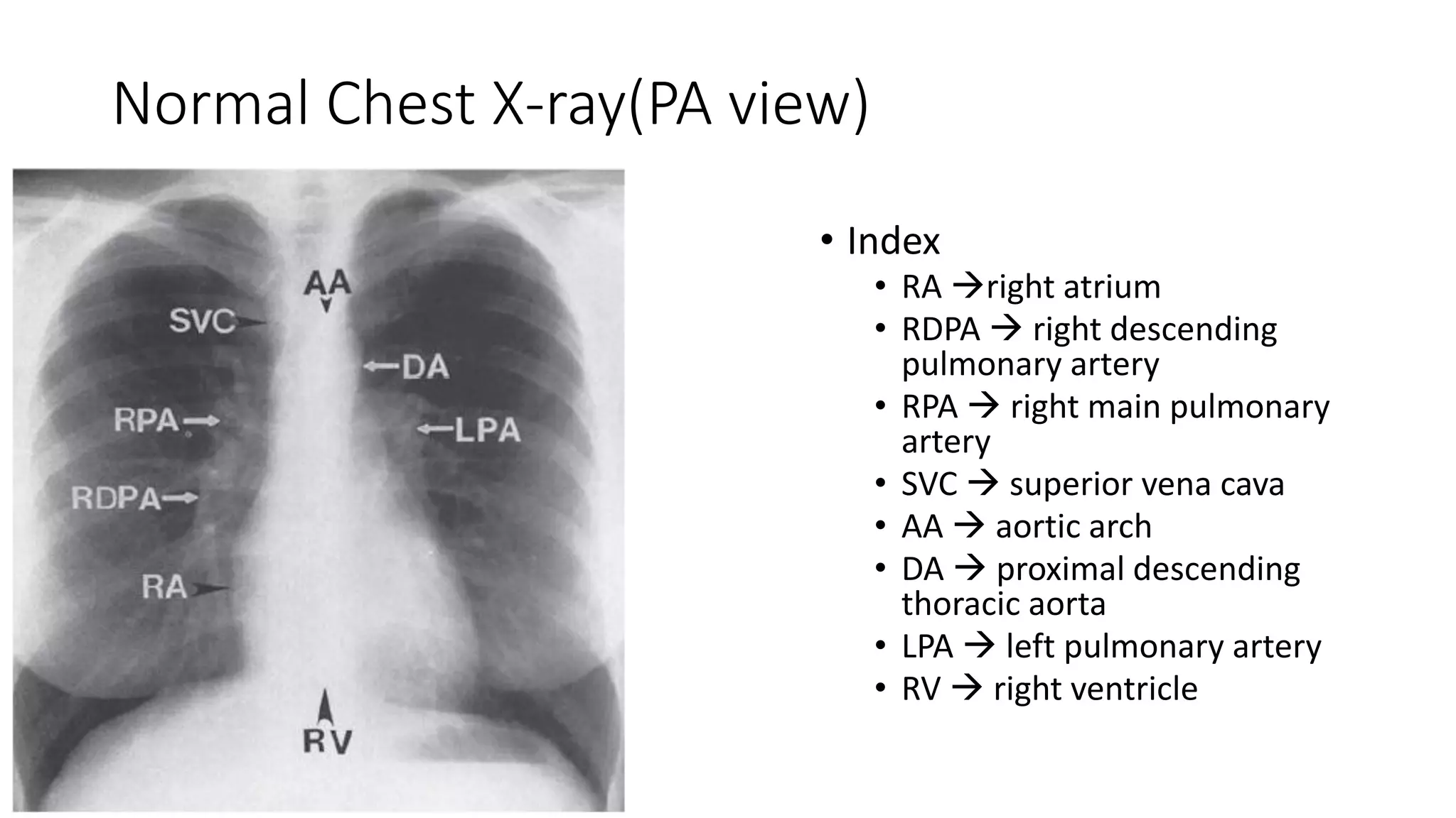 Congenital heart disease and vascular abnormality(x-ray findings) | PDF ...