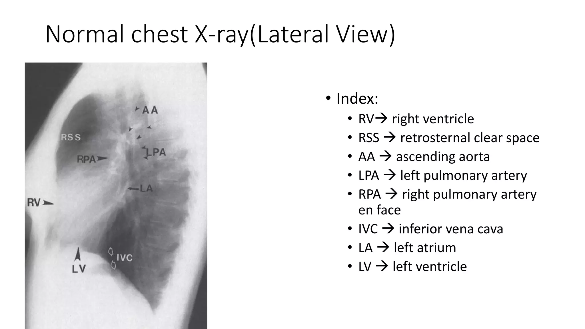 Congenital heart disease and vascular abnormality(x-ray findings) | PDF