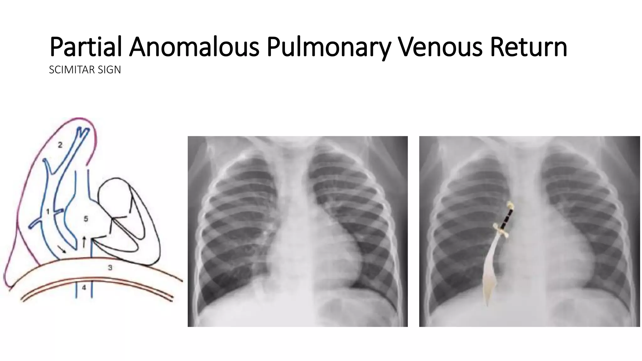 Congenital heart disease and vascular abnormality(x-ray findings) | PDF