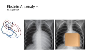 Congenital heart disease and vascular abnormality(x-ray findings) | PDF
