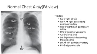 Congenital Heart Disease Xray