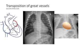Congenital heart disease and vascular abnormality(x-ray findings) | PPT