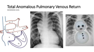 Congenital heart disease and vascular abnormality(x-ray findings) | PPT