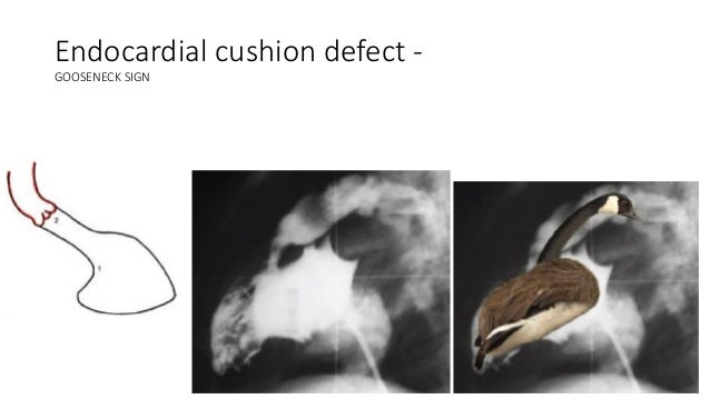 Congenital heart disease and vascular abnormality(x-ray findings)