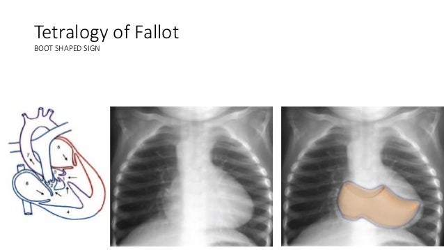Congenital heart disease and vascular abnormality(x-ray findings)