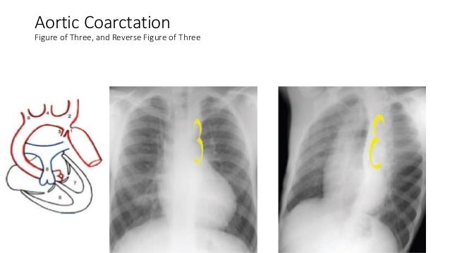 Congenital heart disease and vascular abnormality(x-ray findings)