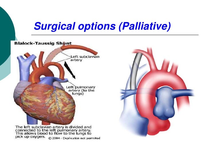 surgery.Congenital heart disease.(dr.aram)
