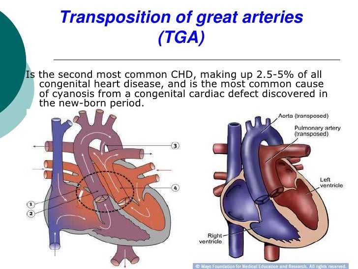 surgery.Congenital heart disease.(dr.aram)