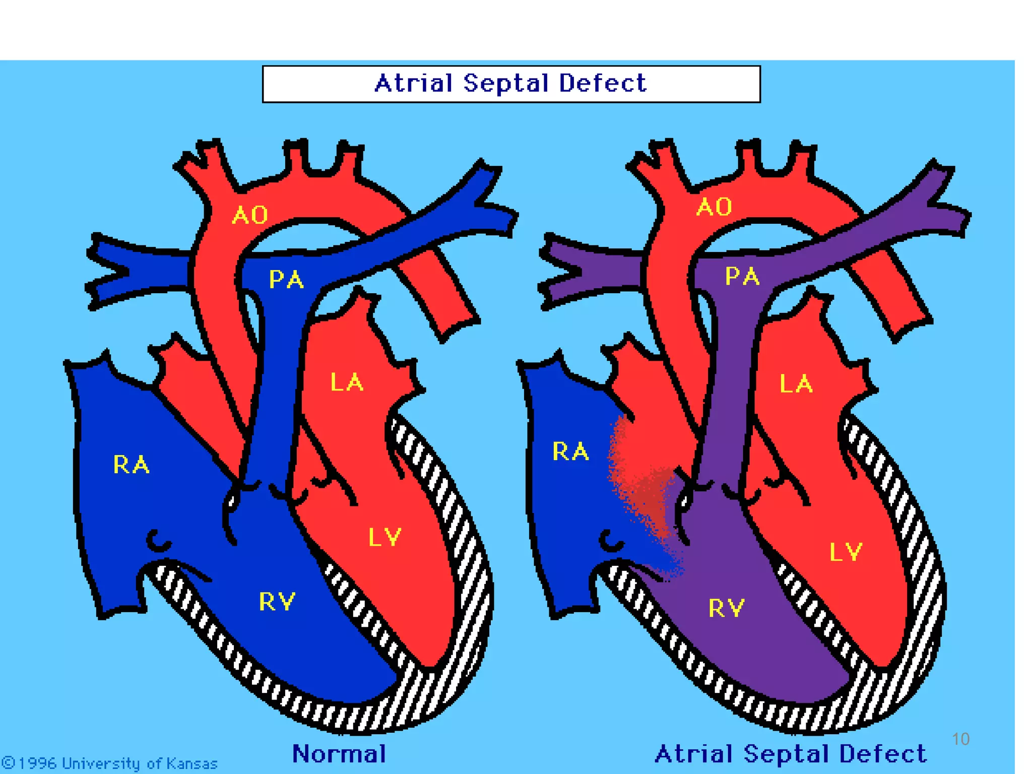Congenital heart disease (chd) | PPT