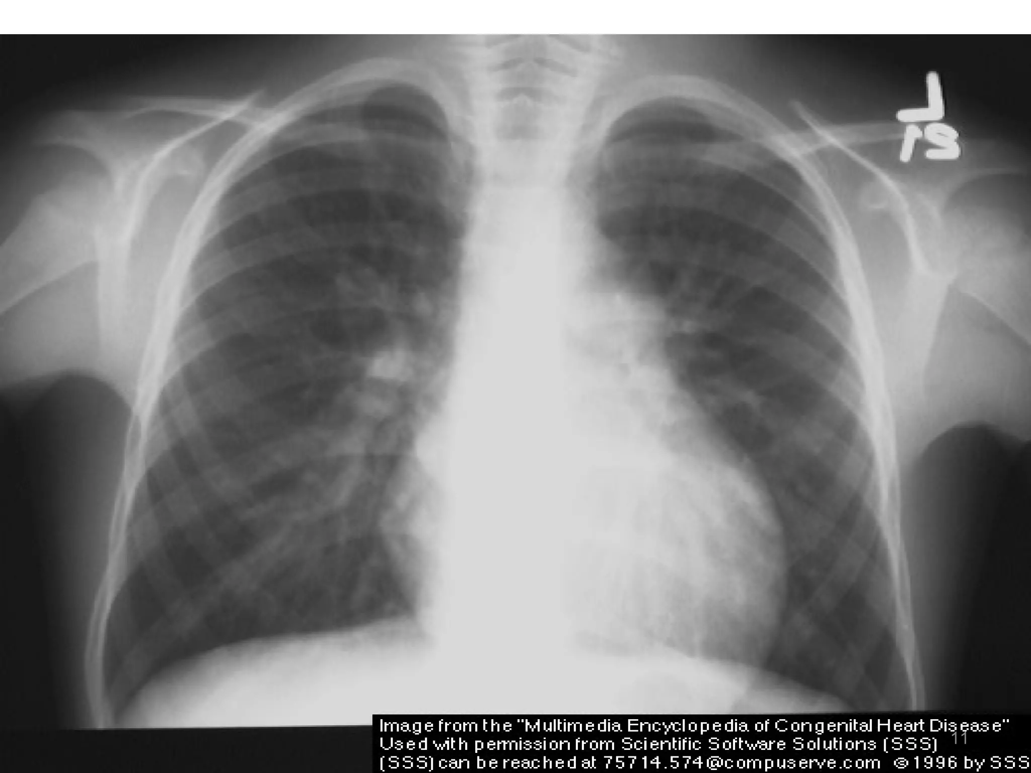 Congenital heart disease (chd) | PPT