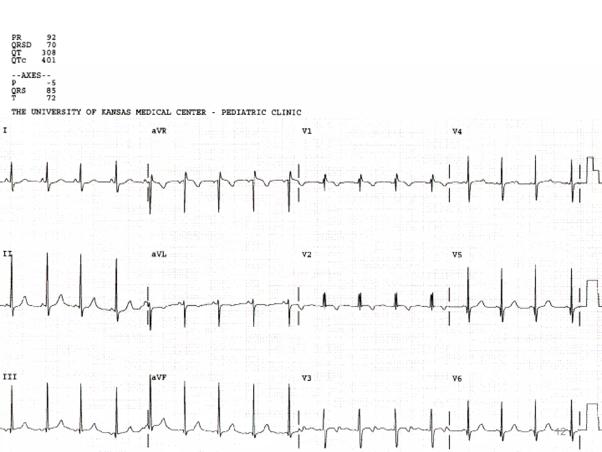 Congenital heart disease (chd) | PPT