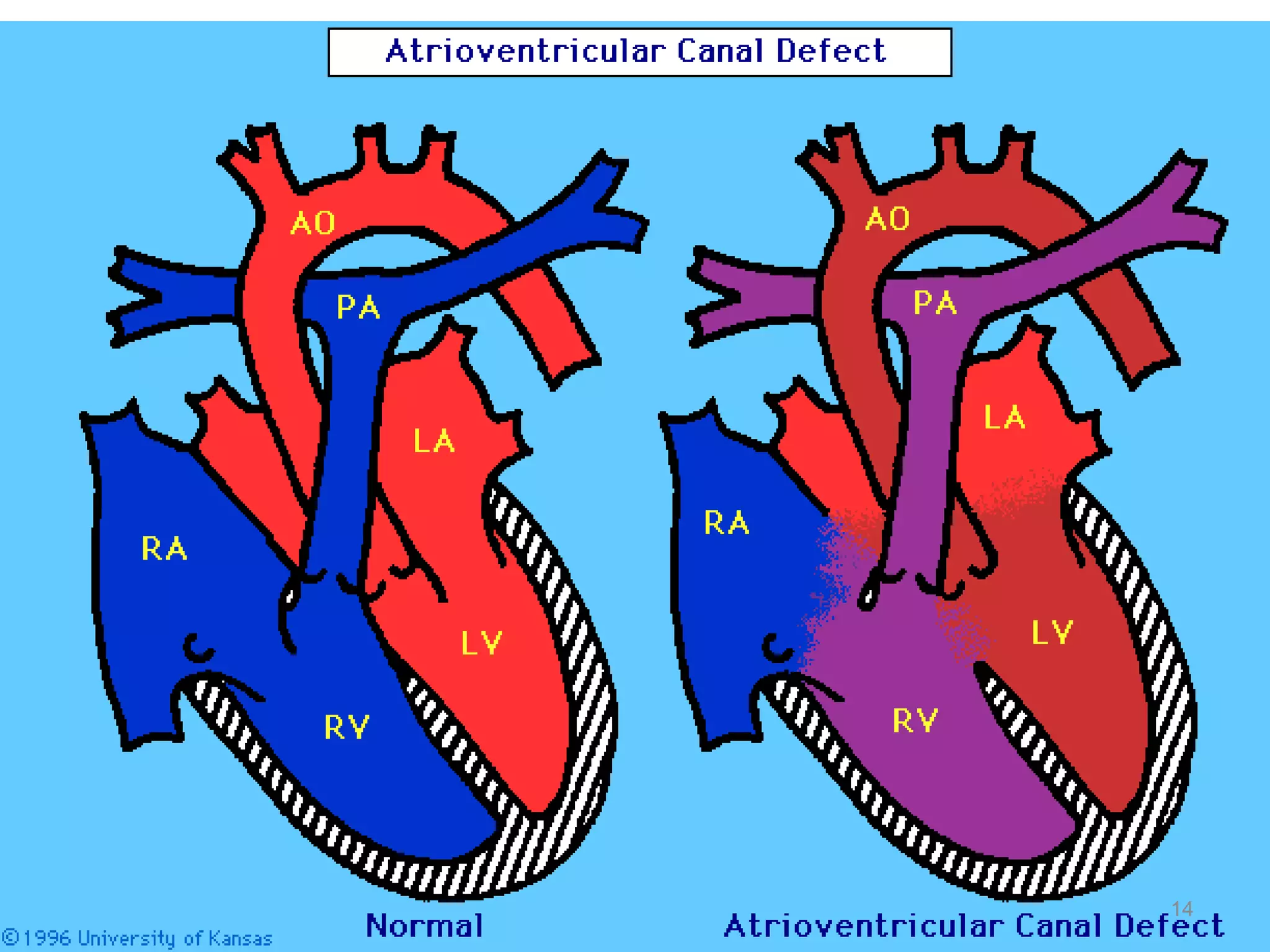 Congenital heart disease (chd) | PPT