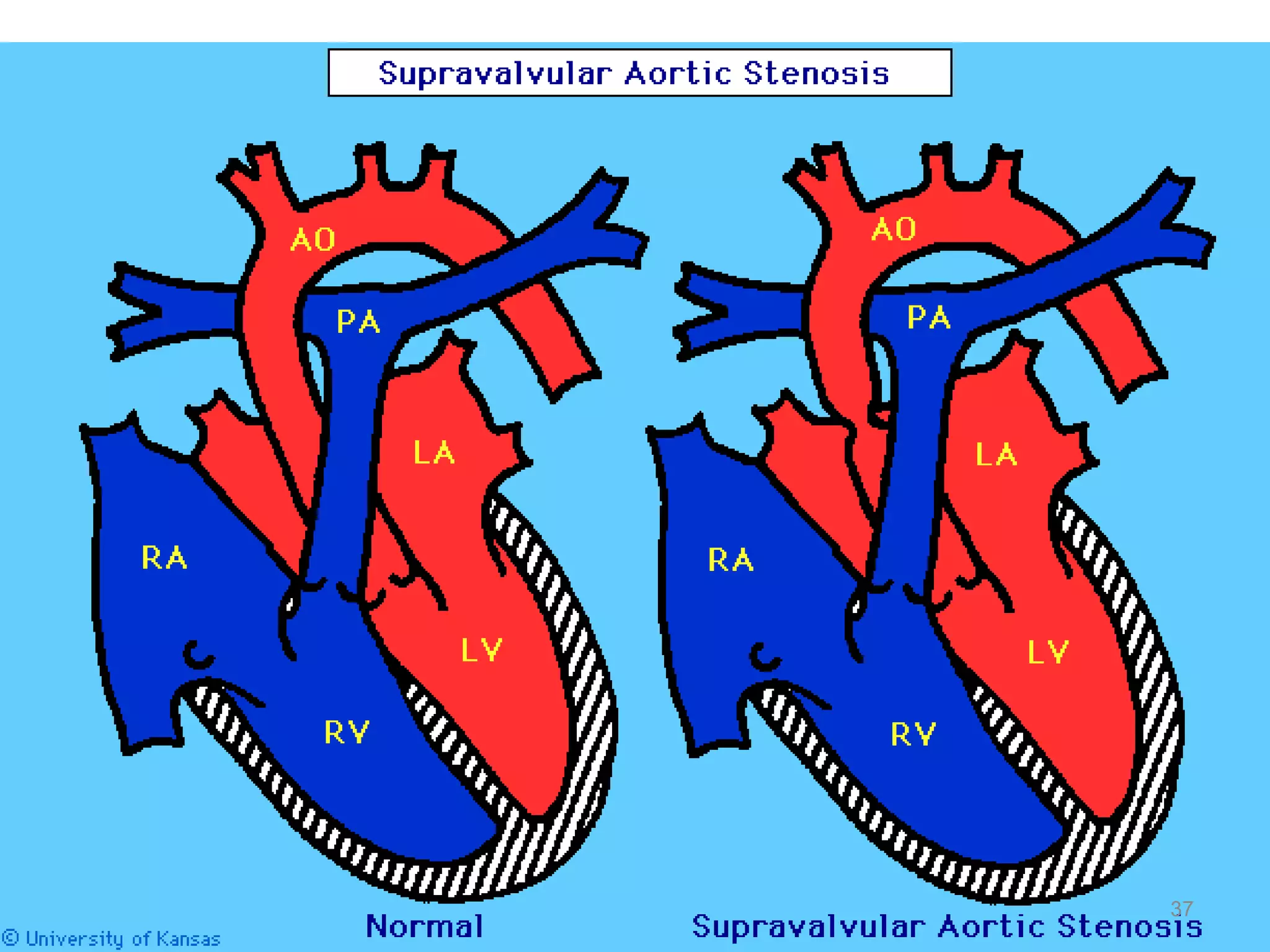 Congenital heart disease (chd) | PPT
