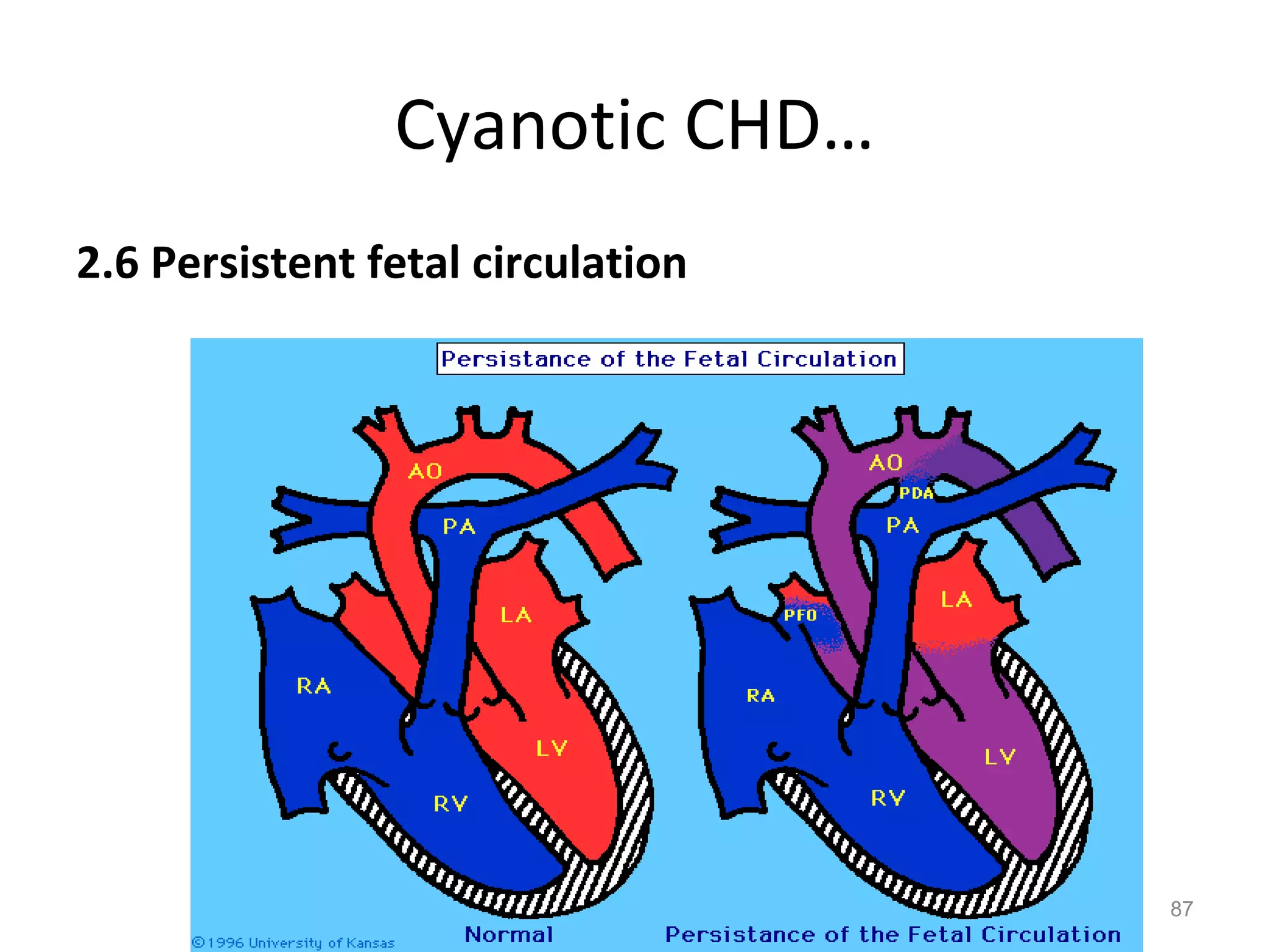 Congenital heart disease (chd) | PPT