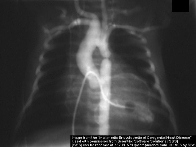 Congenital Heart Disease (CHD)........ppt