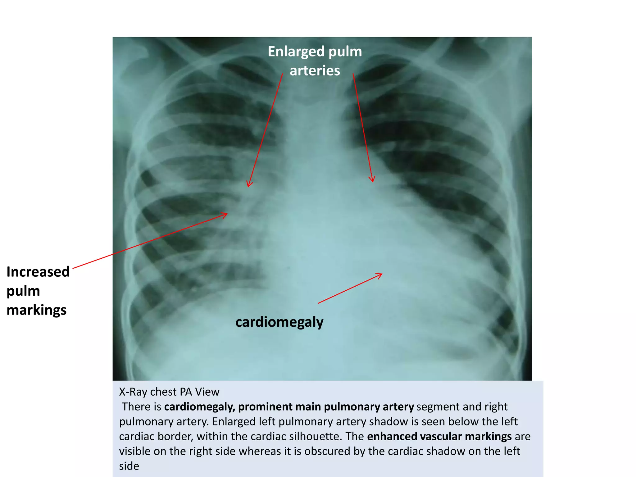 cyanotic and acyanotic Congenital heart disease for undergraduated ...