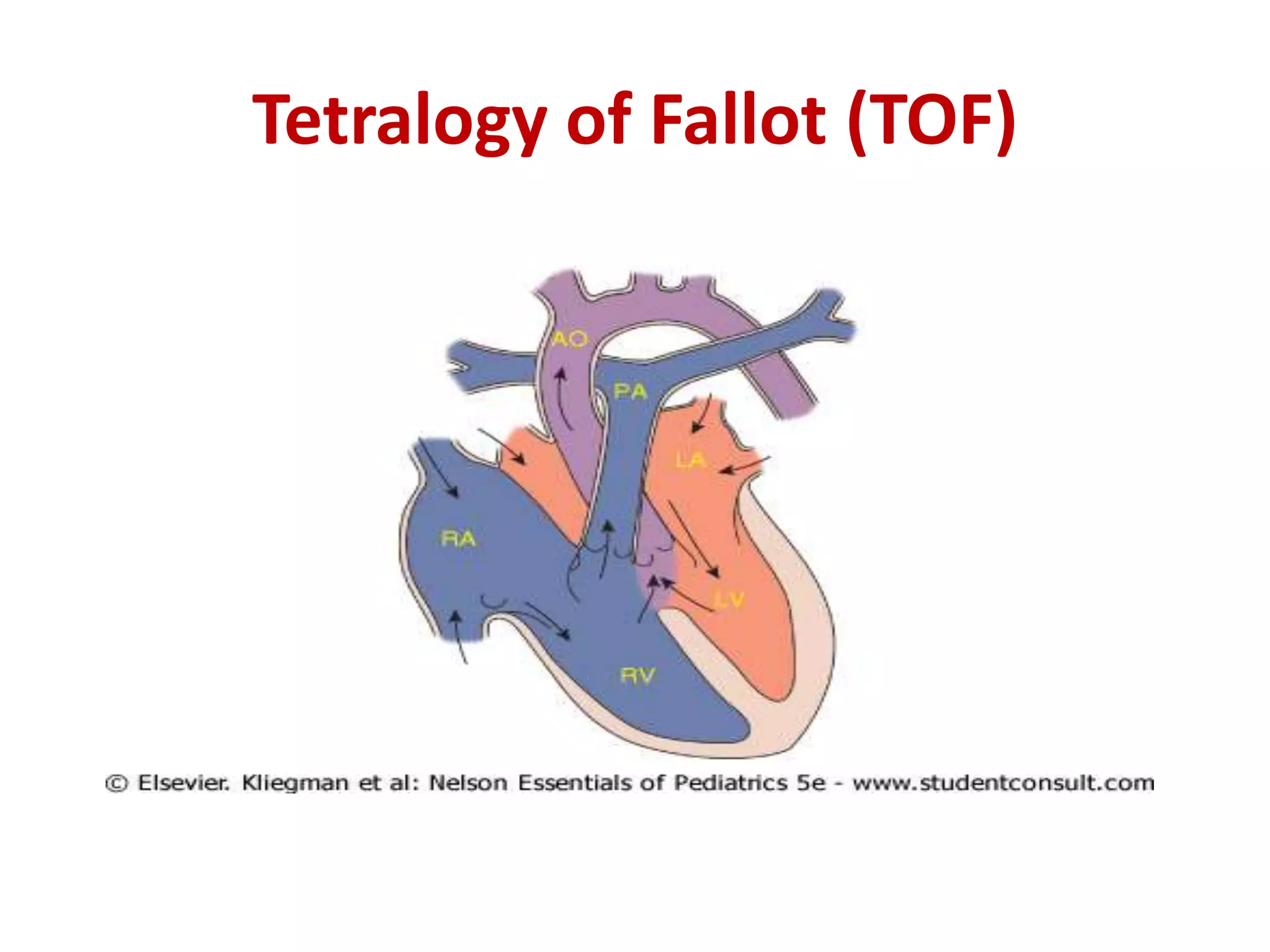 cyanotic and acyanotic Congenital heart disease for undergraduated ...