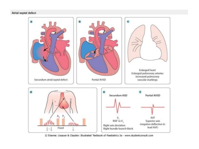 cyanotic and acyanotic Congenital heart disease for undergraduated st…