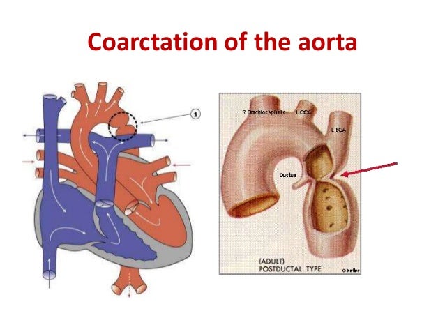 pediatrics congenital heart disease(CHD) – DR. TRYNAADH