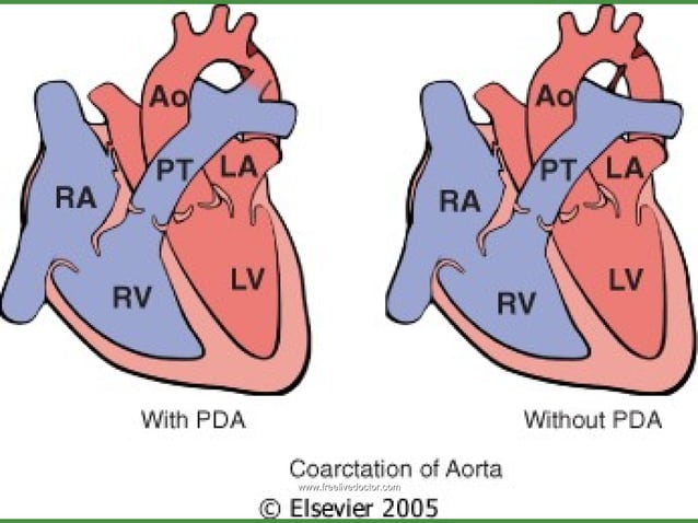 Congenital heart disease heart failure | PPT | Heart and Cardiovascular ...