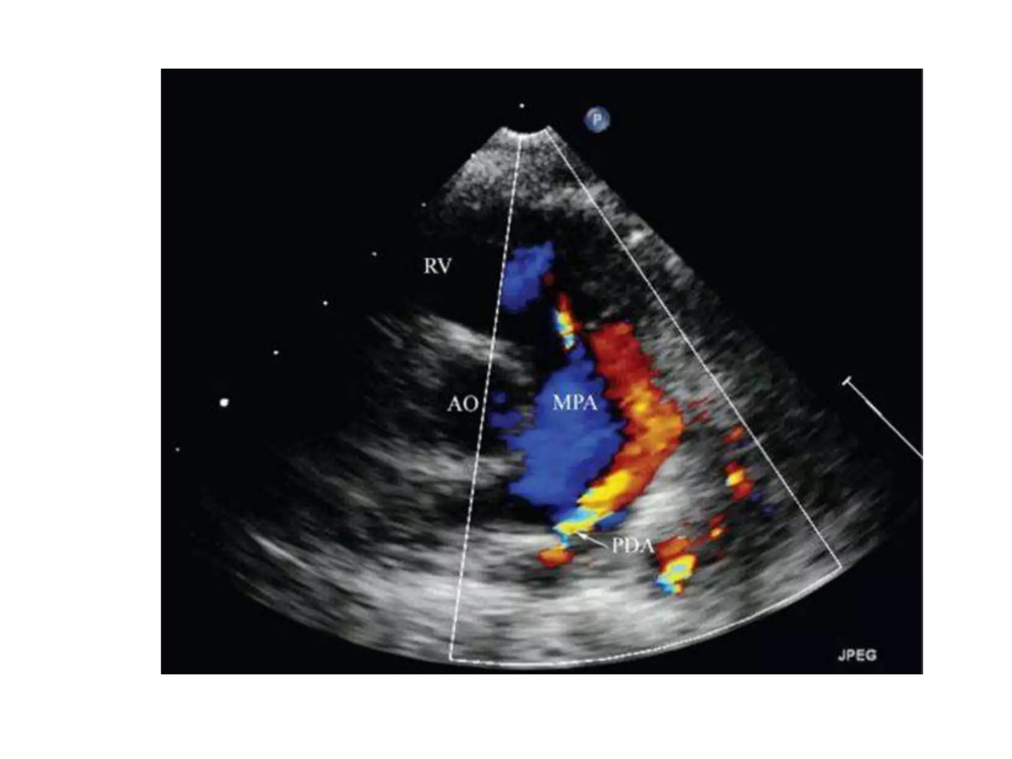 Congenital heart disease part 2.pptx