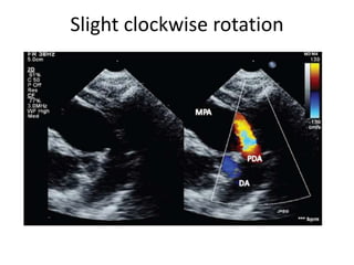 Congenital heart disease part 2.pptx