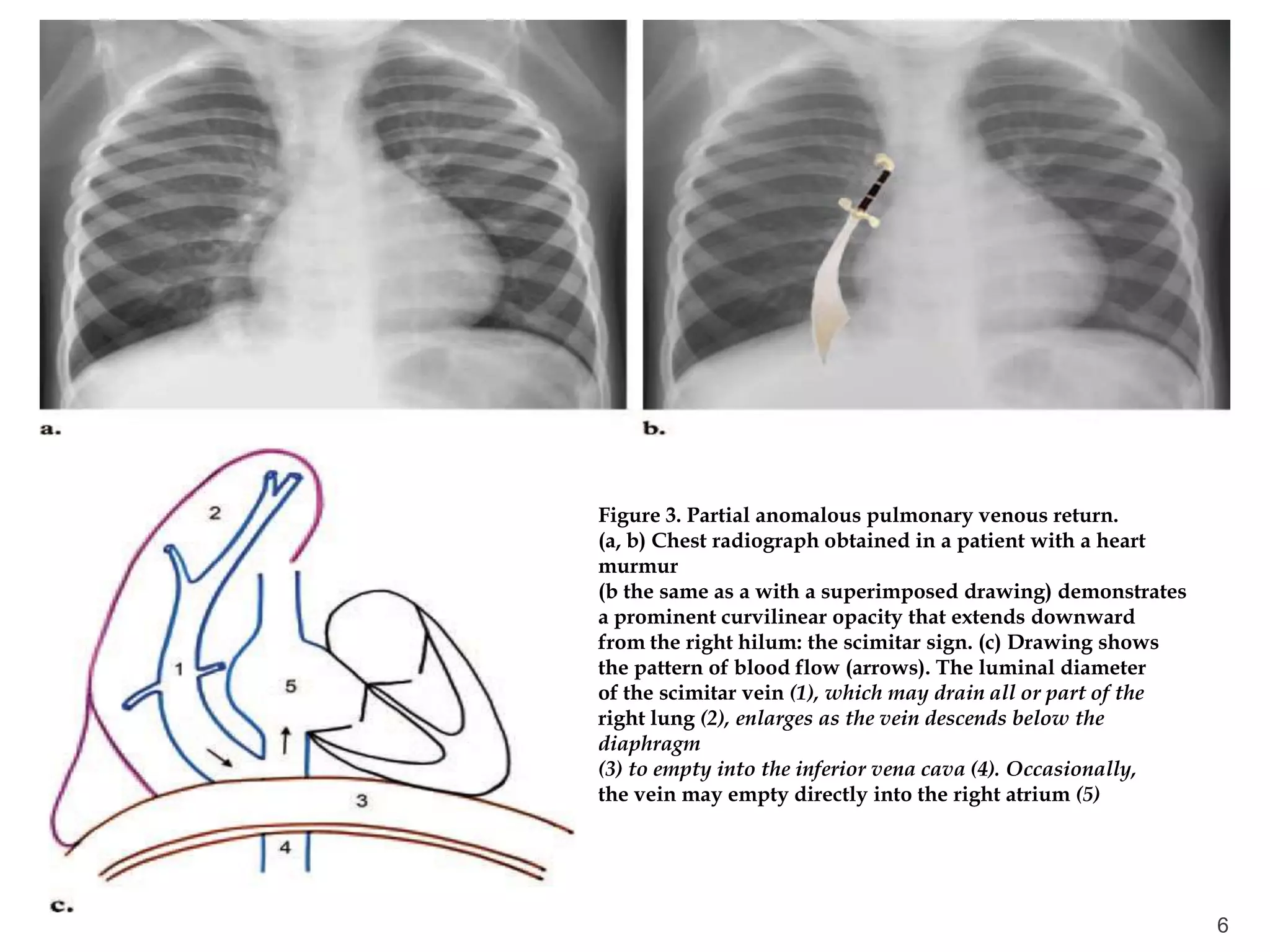 Congenital Heart Diseases | PPTX