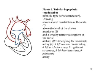 Congenital Heart Diseases | PPTX