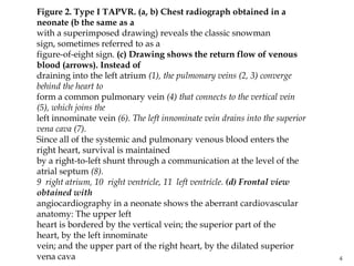 Congenital Heart Diseases | PPTX