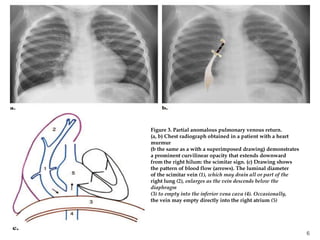 Congenital Heart Diseases | PPTX