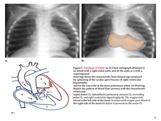Congenital Heart Diseases | PPTX