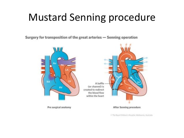 Congenital heart diseases (Cyanotic CHD)