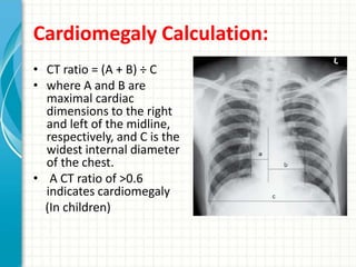 Congenital heart diseases | PPT