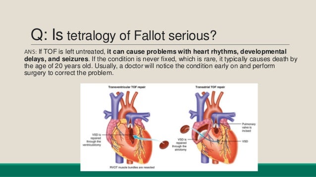 Congenital heart diseases | PPTX