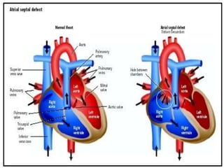 CONGENITAL HEART DISEASES.pptx