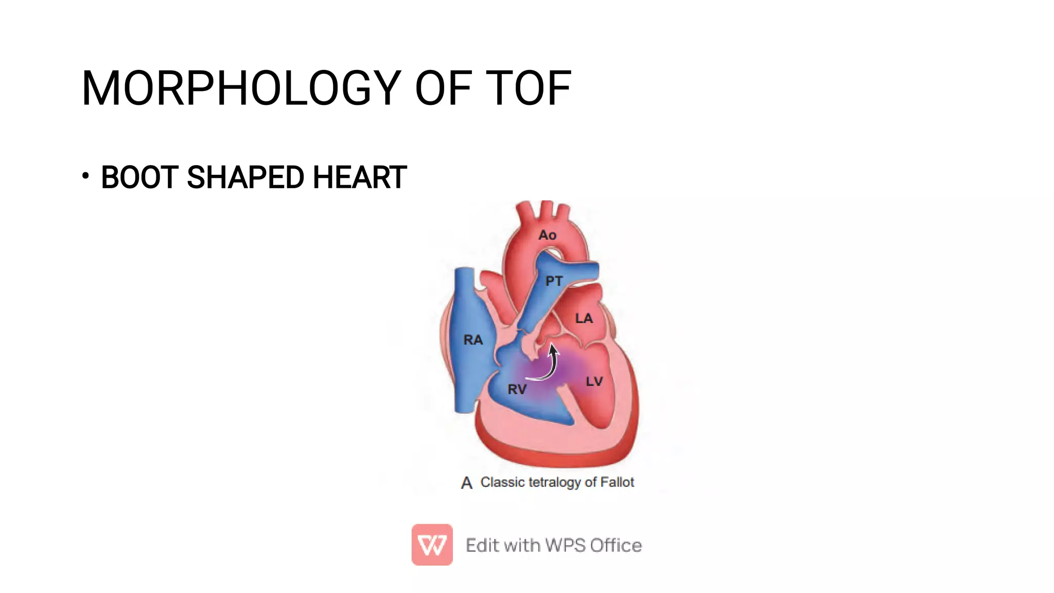 congenital heart diseases.pdf