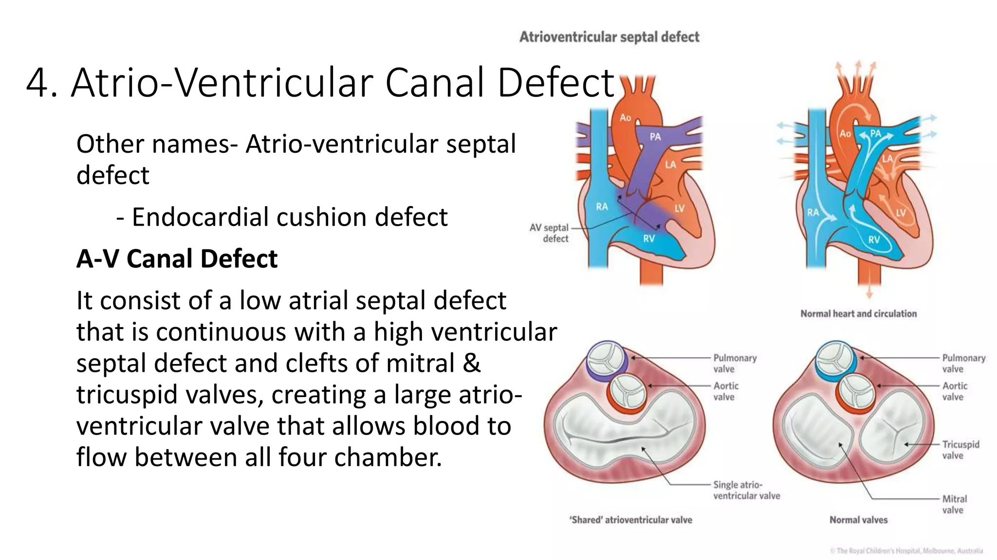 Congenital heart diseases (acyanotic) | PPTX