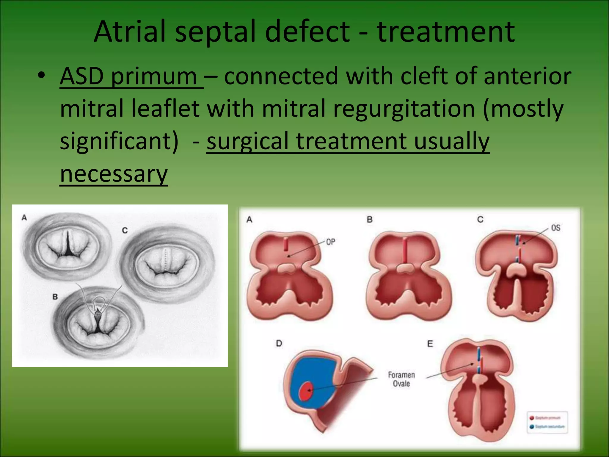 congenital_heart_diseases_in_adults.ppt
