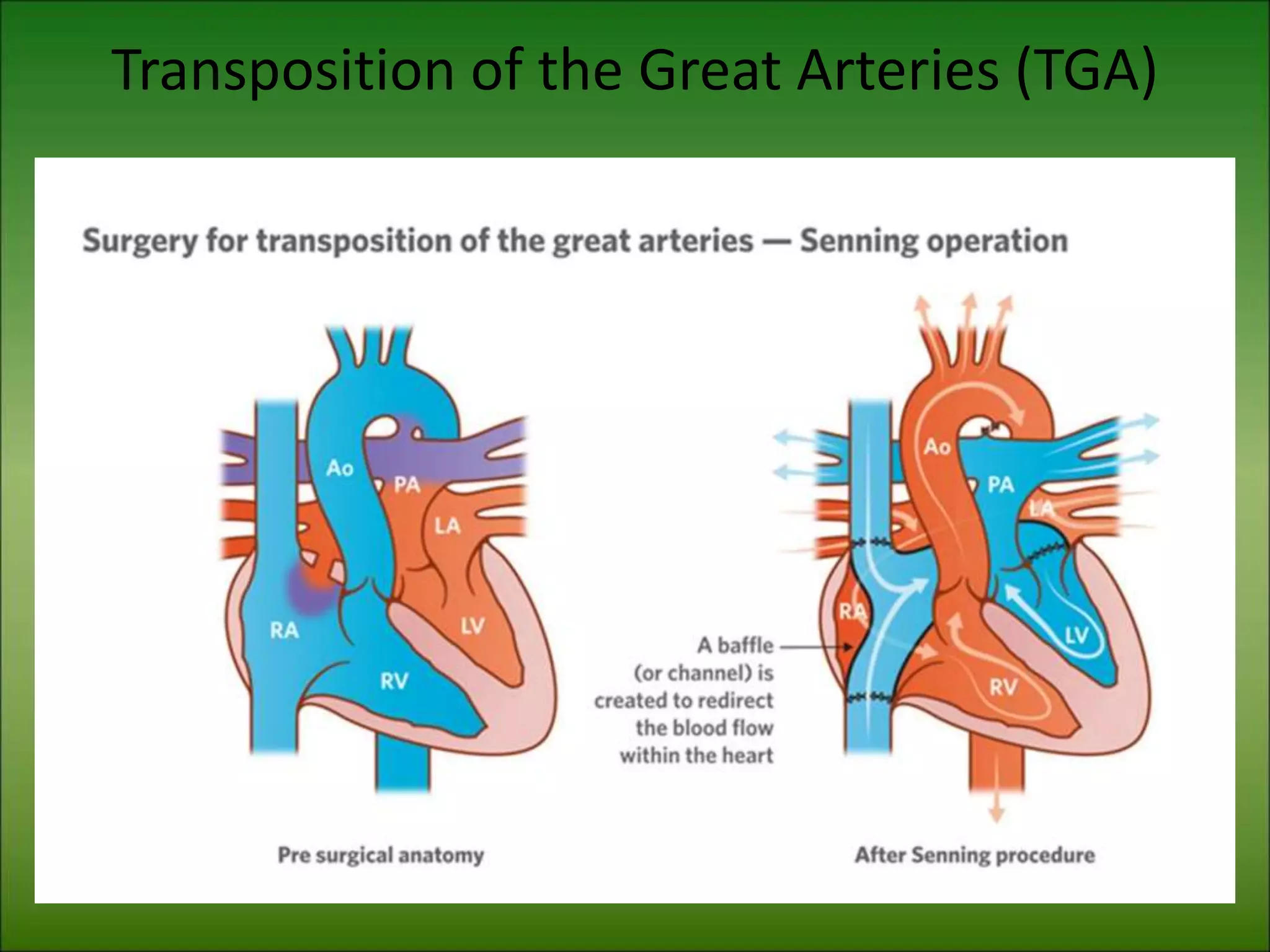 congenital_heart_diseases_in_adults.ppt